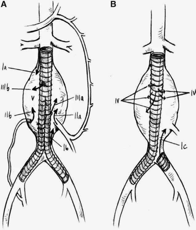 HealthforHeart: Classification of endoleaks after endovascular aneurysm ...