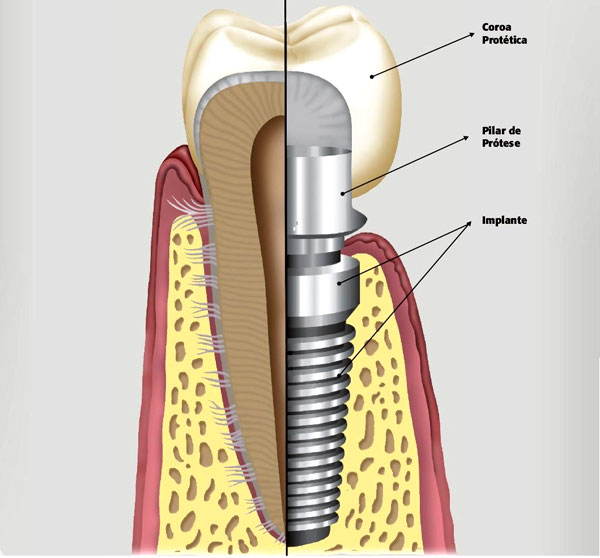 Odonto News.: Pinos e núcleos intra-radiculares X Implante dentário.