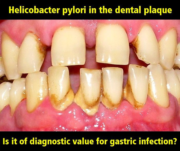 PDF: HELICOBACTER PYLORI in the dental plaque: Is it of diagnostic ...