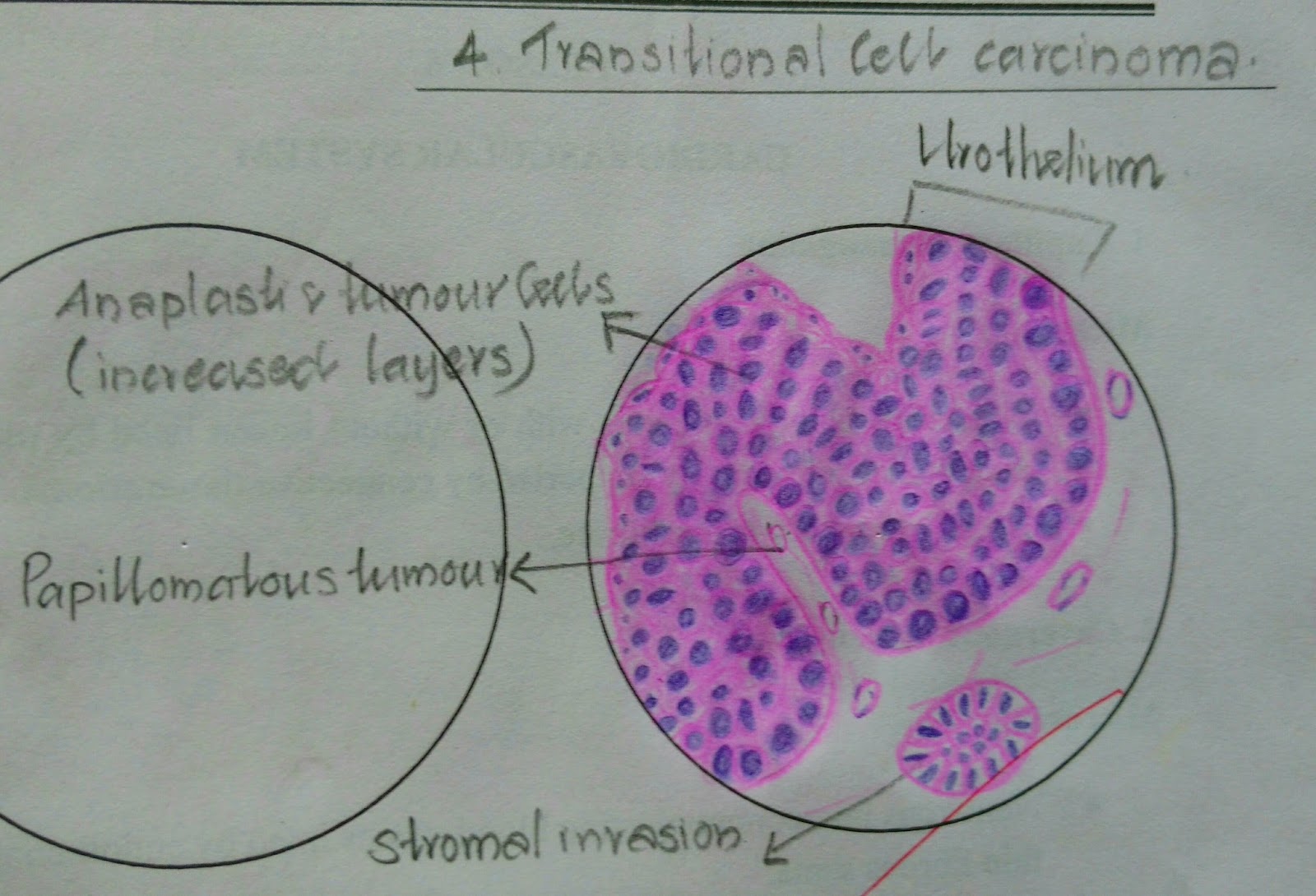 Histopathology Drawings: Transitional Cell Carcinoma
