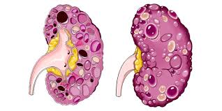 traitement de l'insuffisance rénale: Qu'est-ce que vous devez savoir ...