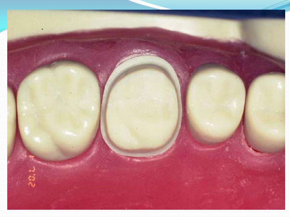 Dentistry: Introduction to Fixed Prosthodontics