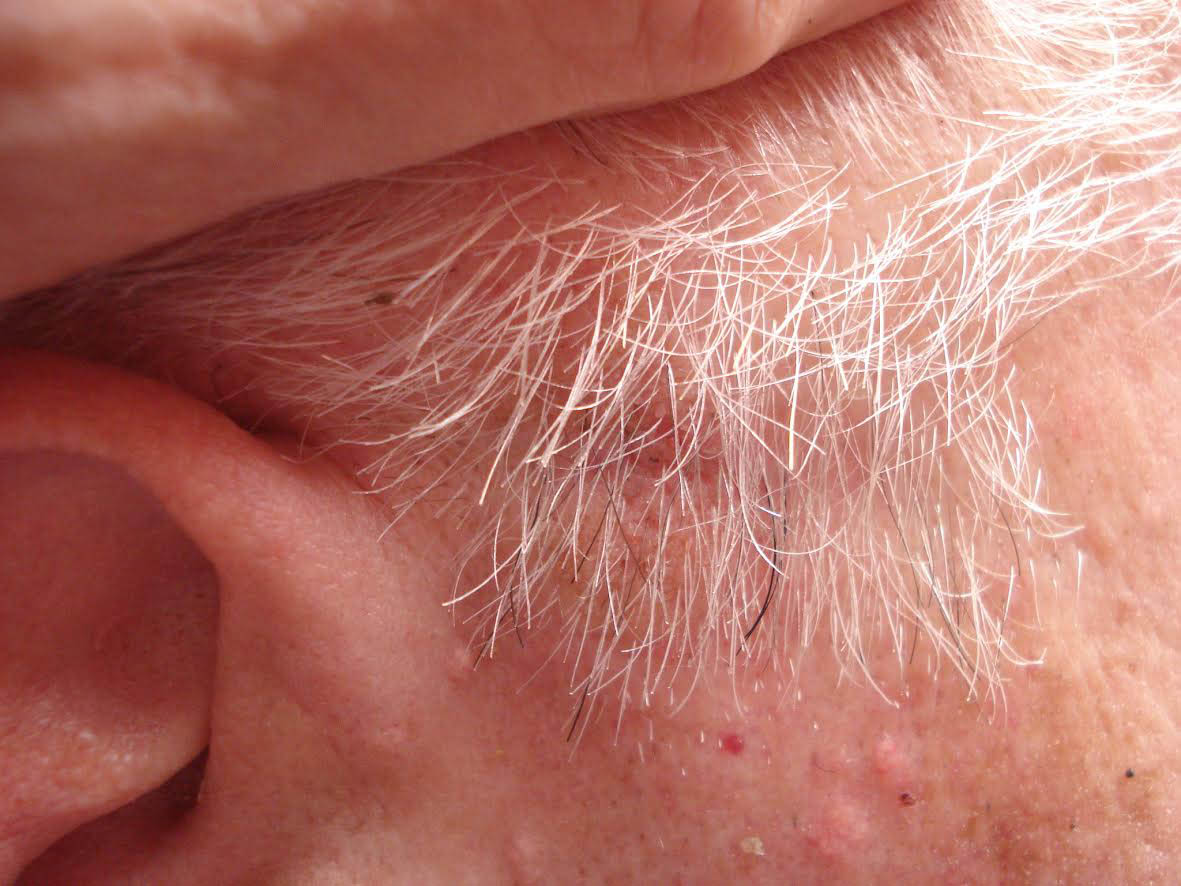 VIRTUAL GRAND ROUNDS IN DERMATOLOGY 2.0: Black Dermographism