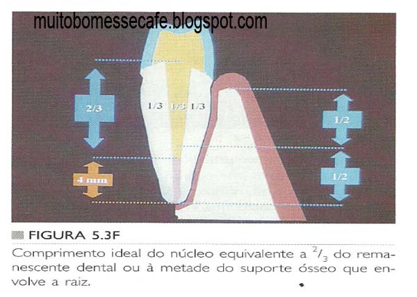 Odontologia : Preparo do conduto