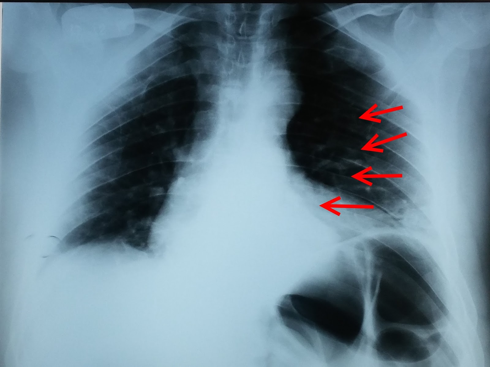 Revision Casos De Cirugia General: TORAX INESTABLE O TORAX FLOTANTE: