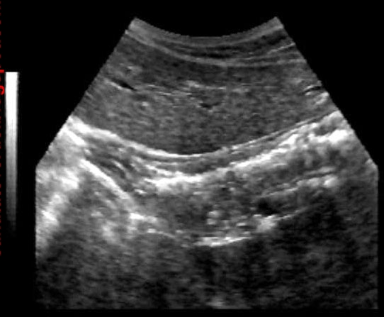 imagini ecografie esofag | Terapii naturiste si Tratamente