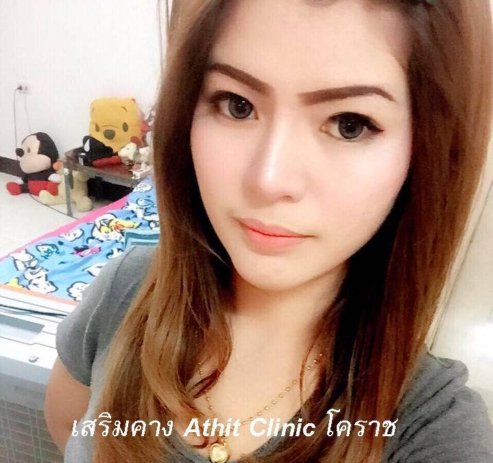 Athit คลินิก โคราช เสริมจมูก คาง ปากกระจับ ตาสองชั้น ลักยิ้ม ร้อยไหม โบท็อก หน้าเรียว ฉีดผิวขาว ...