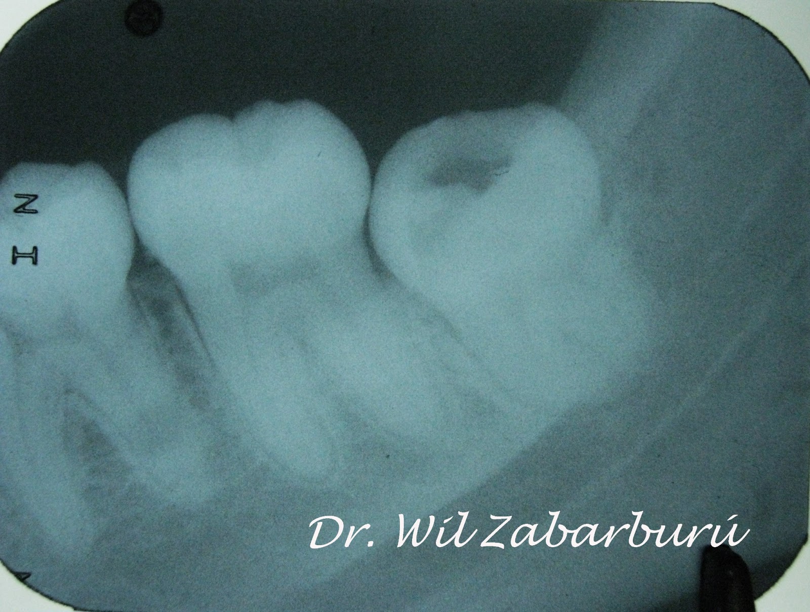 CLINICA DENTAL ASISTENCIAL: TERCER MOLAR INFERIOR SEMIRRETENIDO