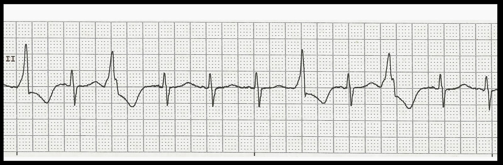 EKG Rhythm Strip Quiz 190
