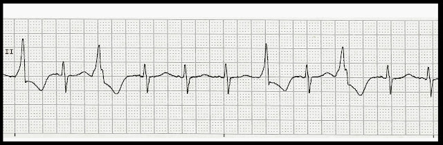 EKG Rhythm Strip Quiz 190
