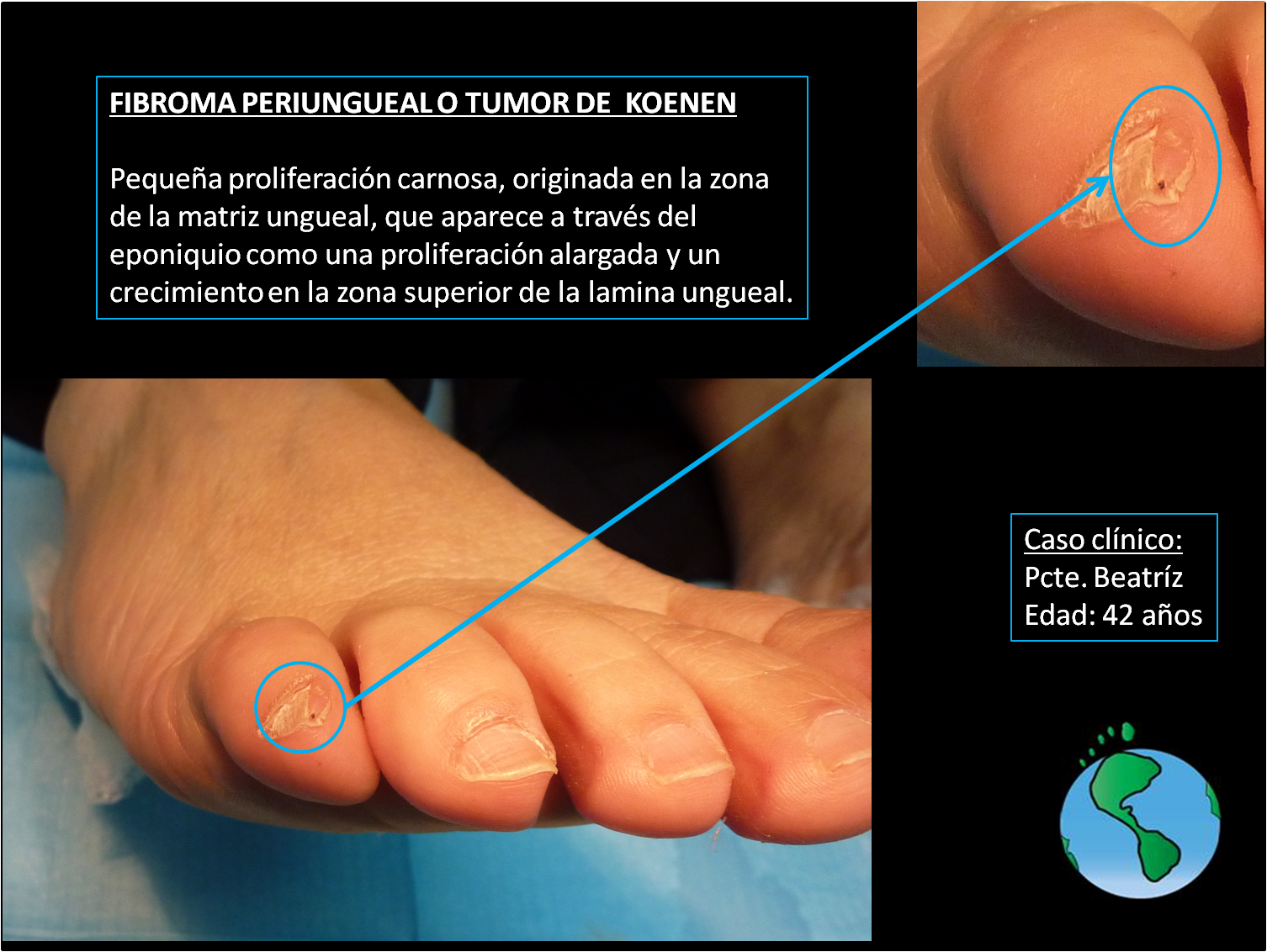 PODOLOGIA: LOS PIES SOBRE LA TIERRA: FIBROMA PERIUNGUEAL