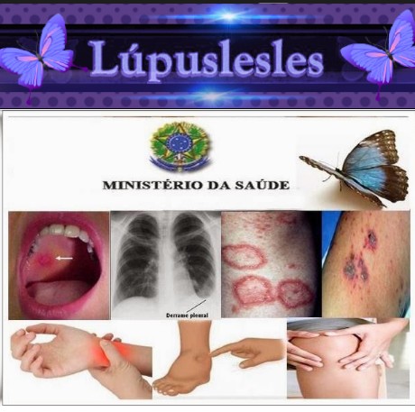 Lúpuslesles: Protocolo clínico do Lúpus eritematoso sistêmico ...