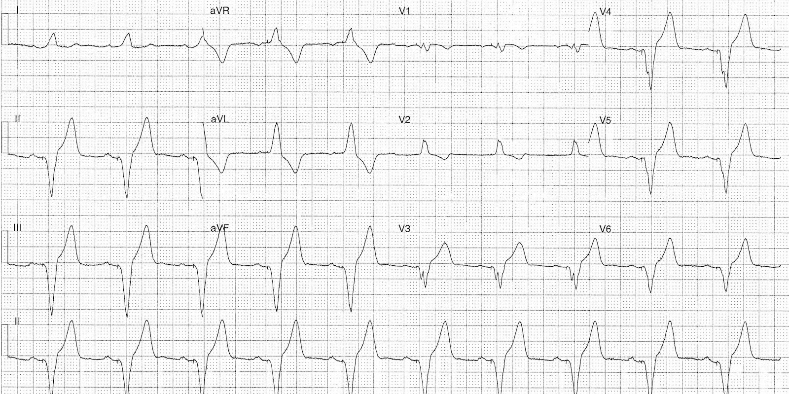 ECG of the Week: ECG of the Week - 8th August 2016 - Interpretation