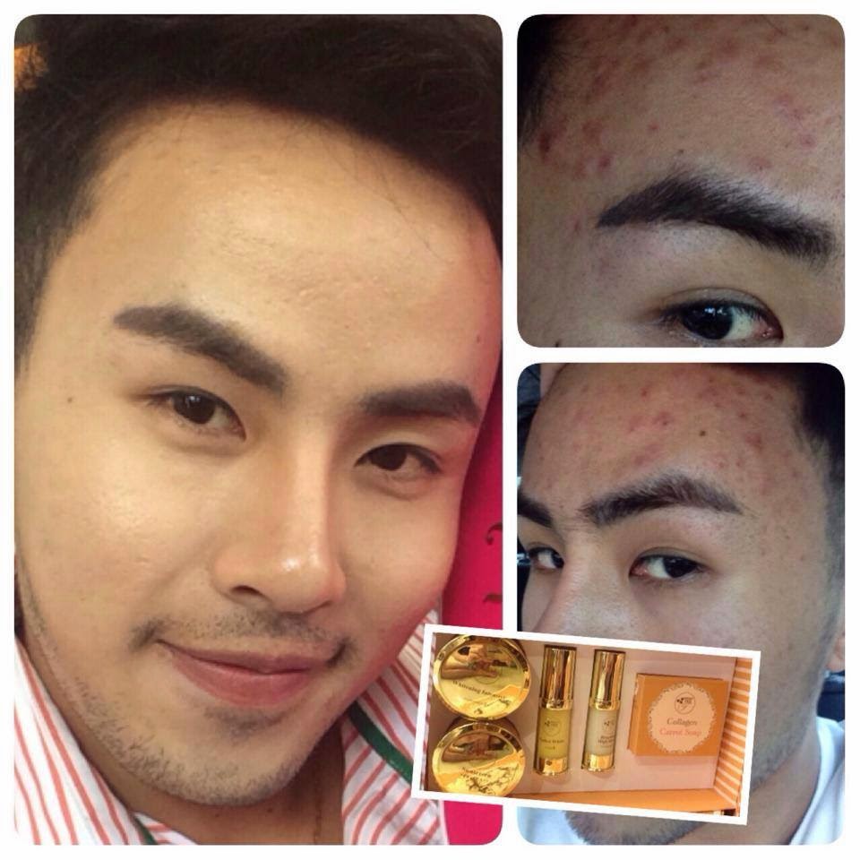 #1 Thailand Skin Whitening Products: Freshy Face Gold Set Users Before ...