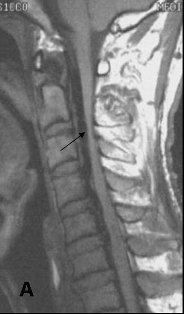 MRI MEDIC CASE STUDIES COLLECTION: Ossification of the posterior ...