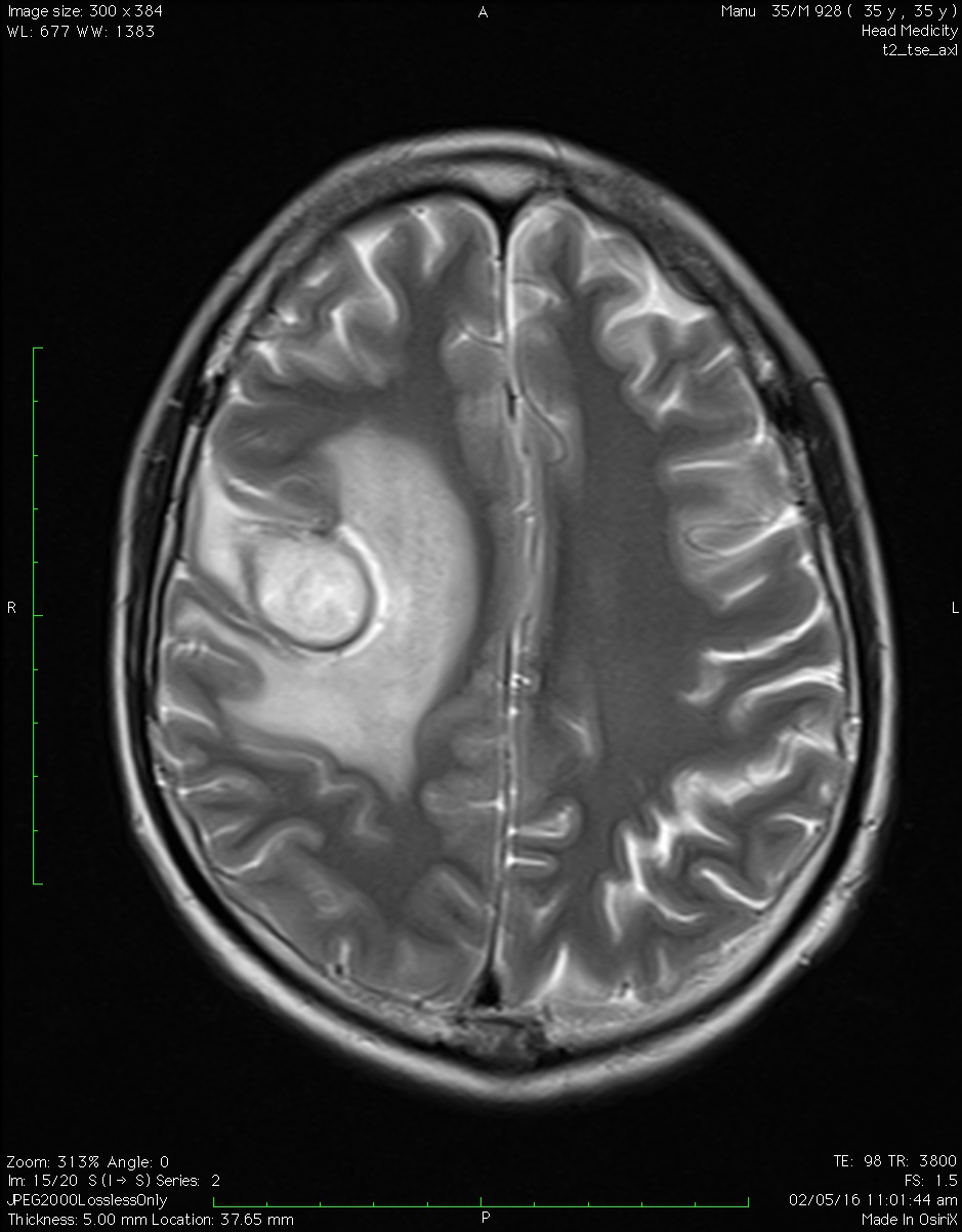 Ultimate Radiology : Frontal lobe abscess : follow up MRI