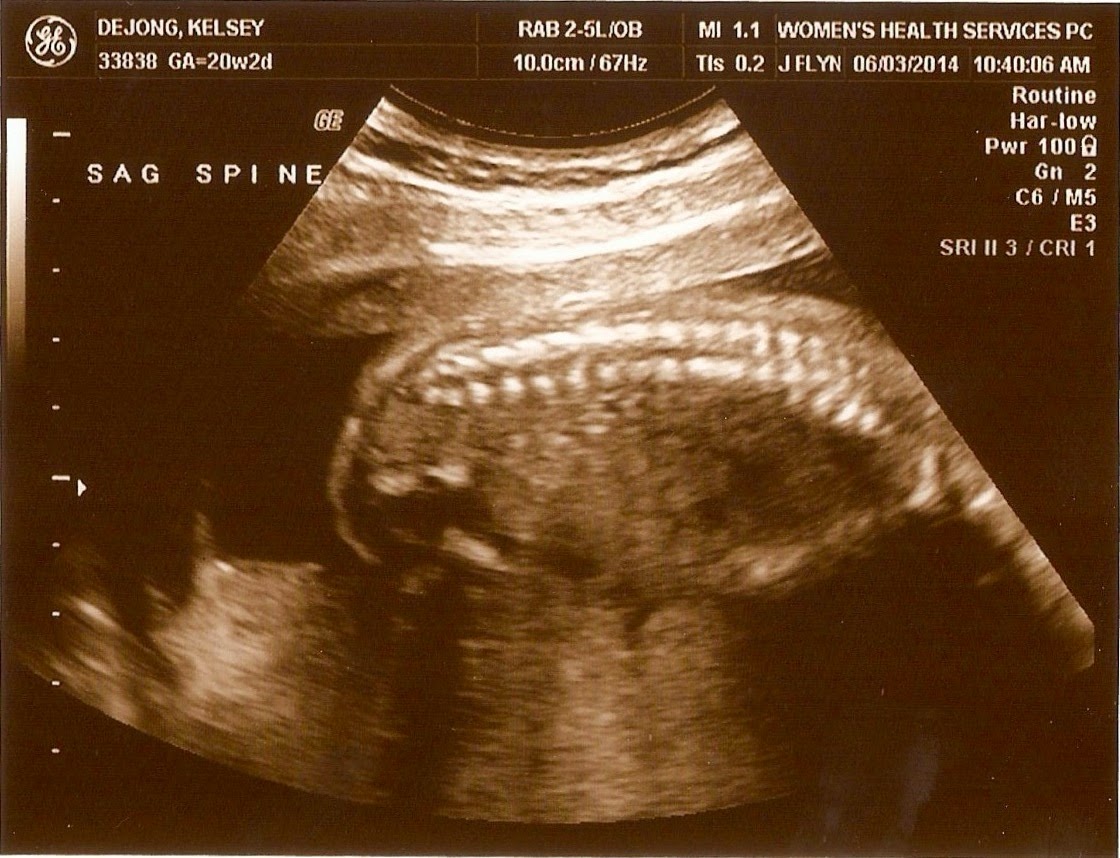20 Weeks Ultrasound