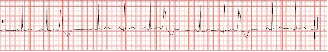 Float Nurse: EKG Rhythm Strips 37