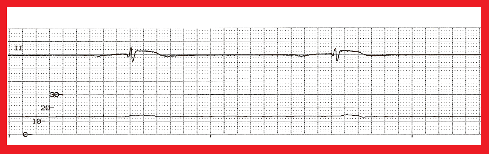 Various Agonal Rhythms
