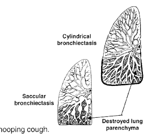 Bronchiectasis def., causes,clinical picture, investigations ...