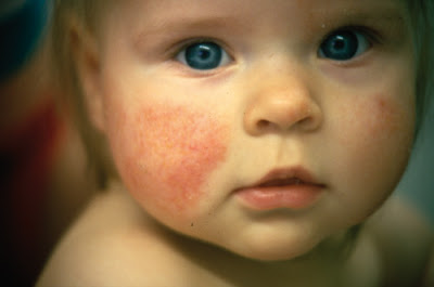 Erityiskysymykset : Portfolio: Atooppinen ihottuma