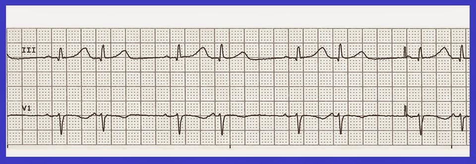 Various Rhythms with PACs