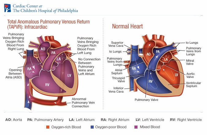Cole's Heart Journey: TAPVR HEART