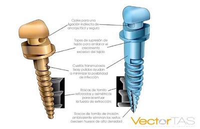 ORTODONCIA: Uso de mini implantes VECTOR TAS - Dr. Héctor M. García ...