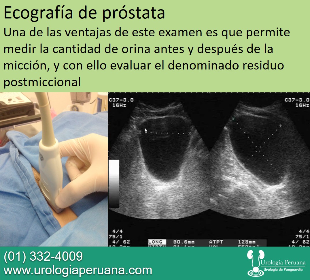 Midiendo la orina residual en los pacientes con próstata