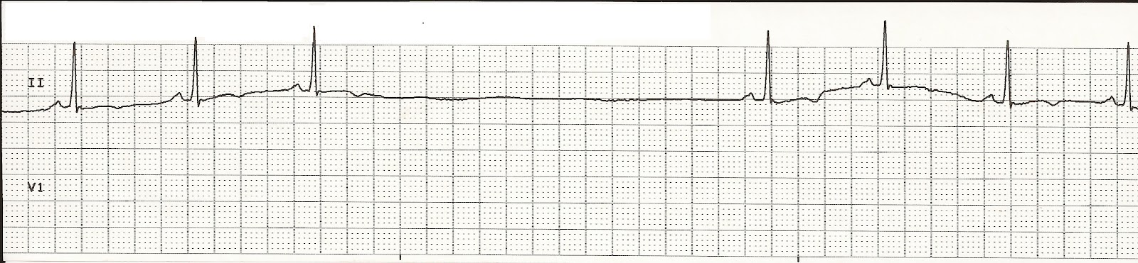 Identify the pharmacologic therapy for the following rhythms.