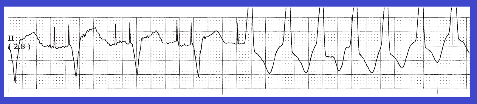 Practice EKG Strips 398