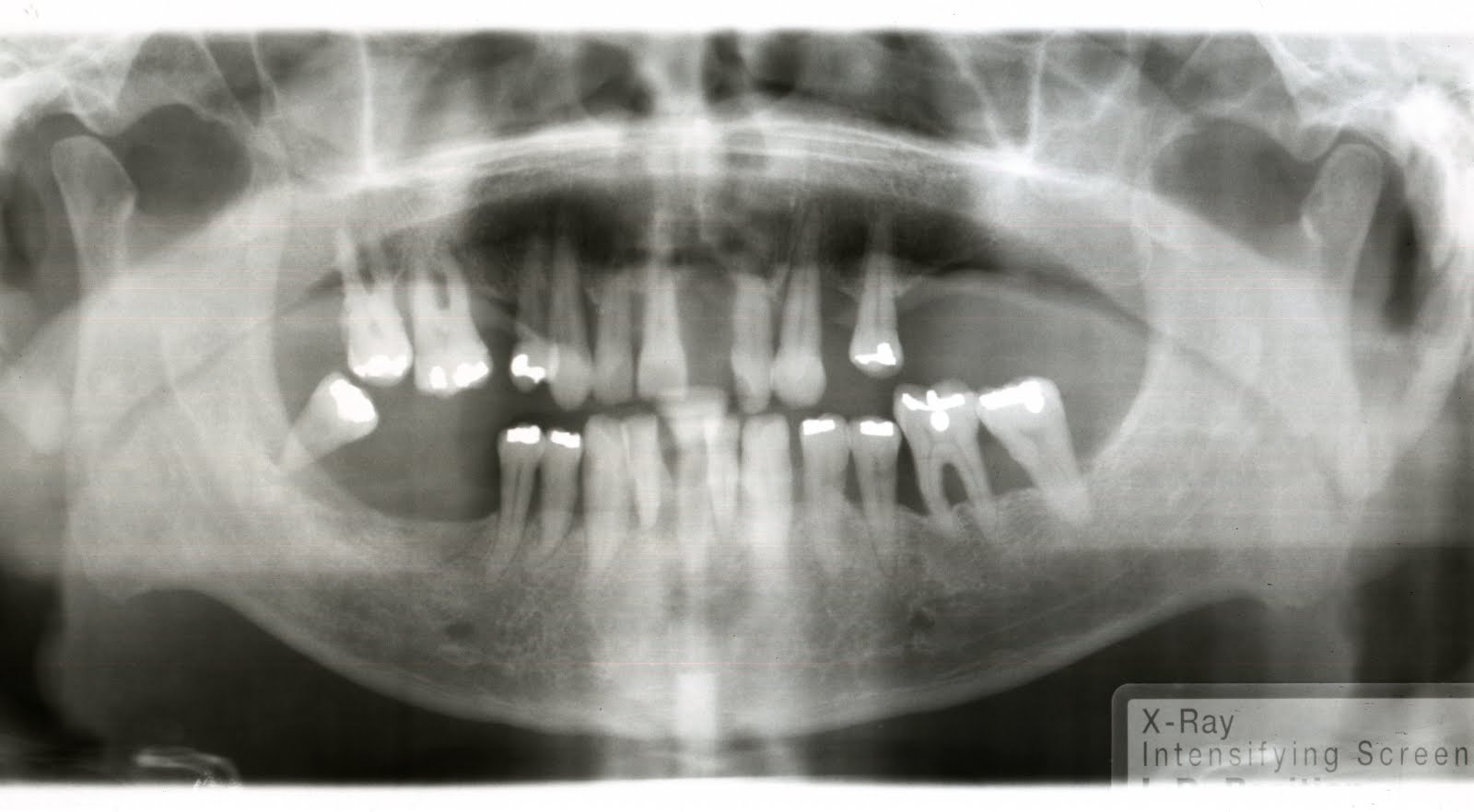 Casos Clínicos UDental: Periodontitis crónica avanzada generalizada