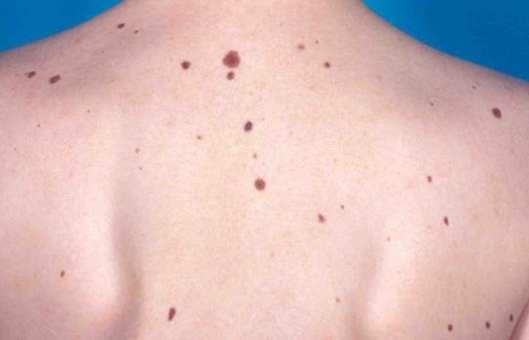 Ciri Ciri Kanker Kulit yang Perlu Anda Kenali Sejak Dini | BlogDokter