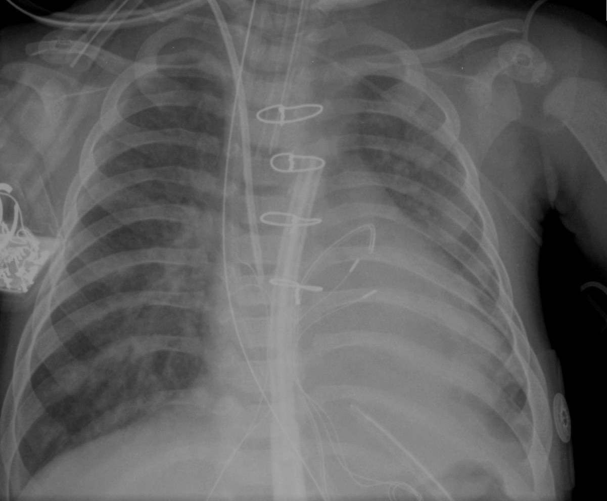 PediCardiology Quiz Answers: Quiz #9: Where is the tip of the PA line?