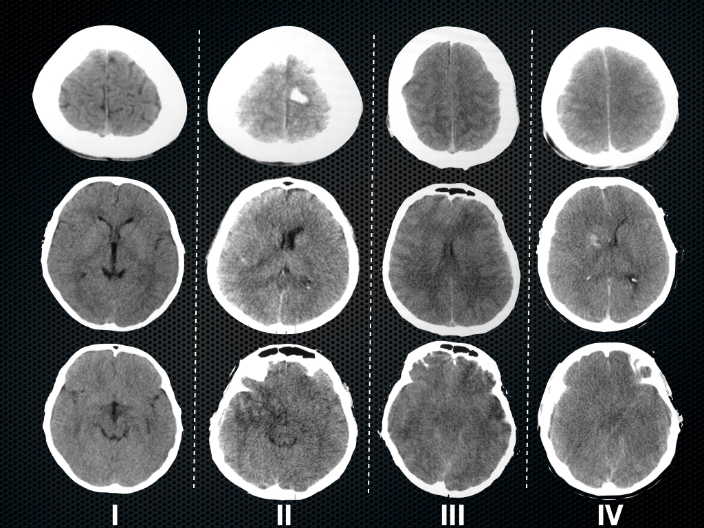 NEUROINTENSIVISMO: Classificação Marshall versus Hipertensão Intracraniana