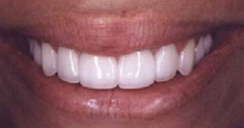 Porcelain Veneers & Alternative Treatments