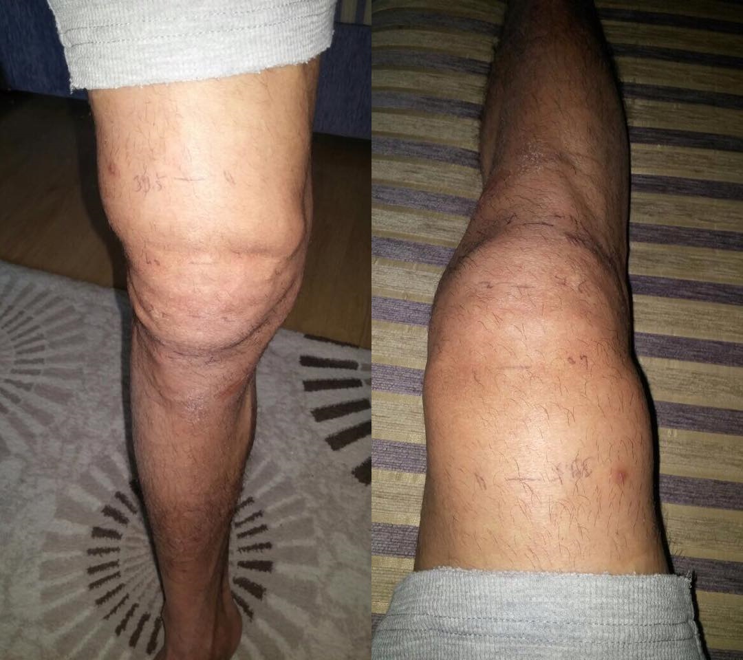 Ön Çapraz Bağ Dizde Şişlik ve Ödem - Ön Çapraz Bağ