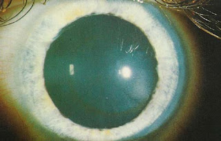 Images For Kayser Fleischer (KF) Ring - Wilson's Disease ~ YOUNG ...
