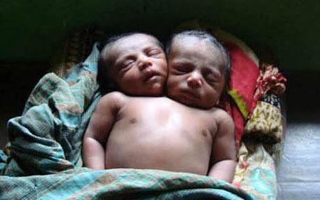 A baby with two heads born in Brazil | Human Relations