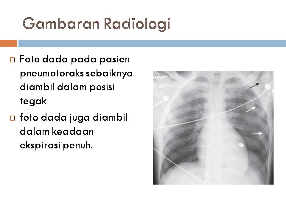 Gambaran Radiologis Pneumotoraks