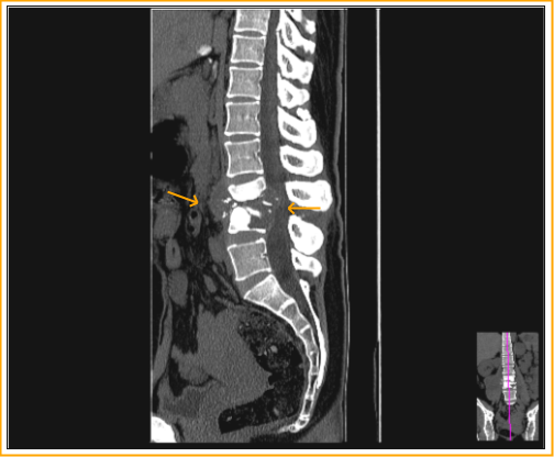Pott's Spine: CT - Radiology Imaging