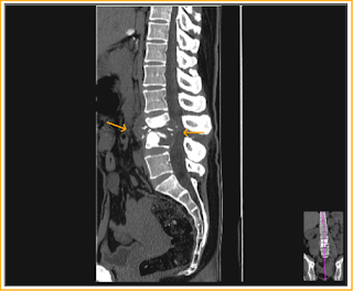 Pott's Spine: CT - Sumer's Radiology Blog