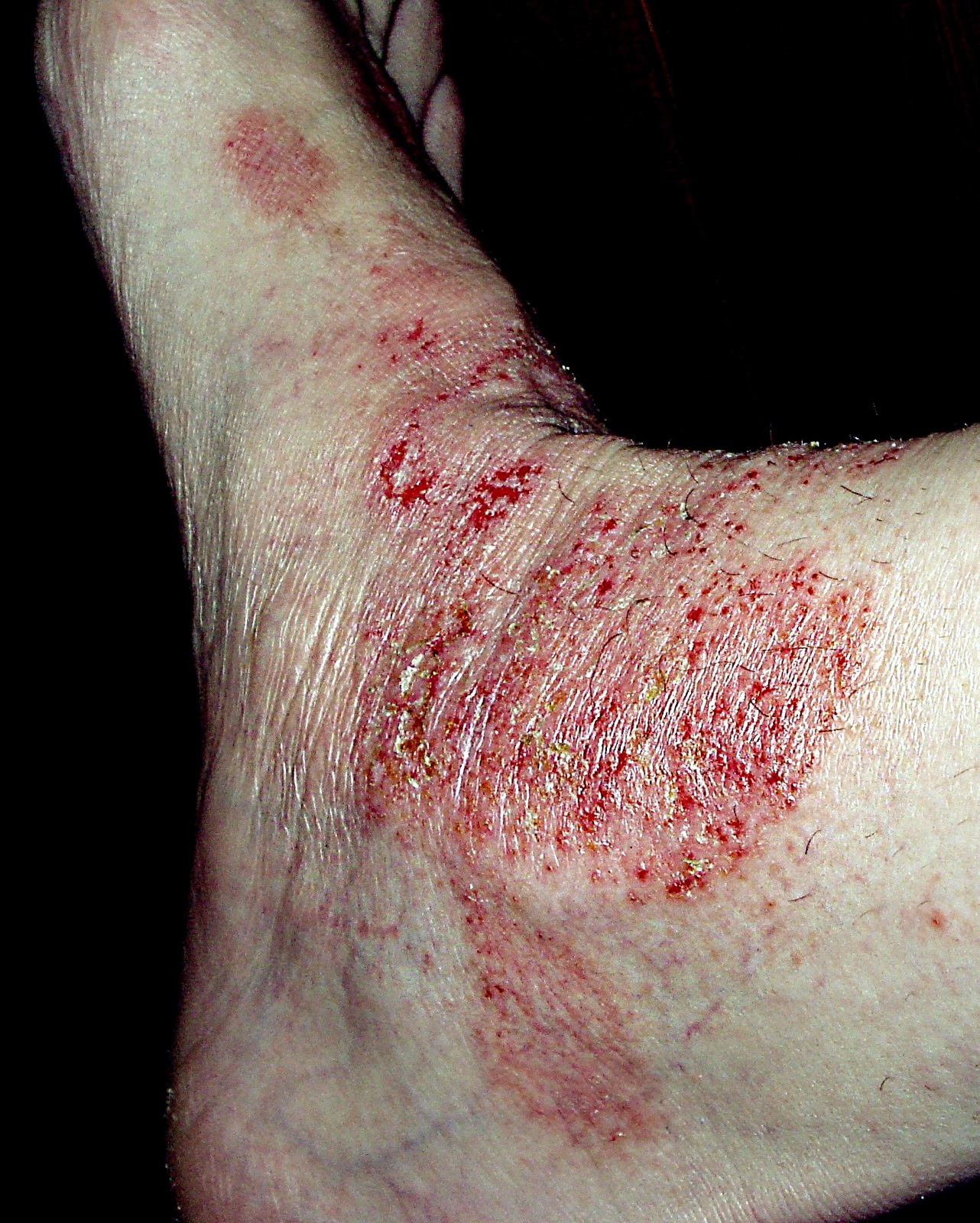 StRaDdLiNg ReAliTiEs: Morgellons: The Disease that Doesn't Exist, But Does.