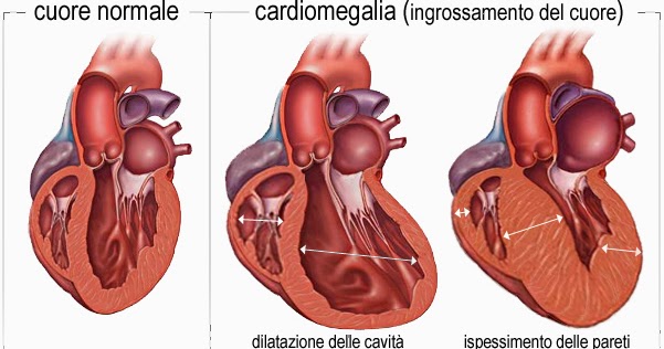 La cardiologia y la cirujia cardiaca: Cardiomegalia