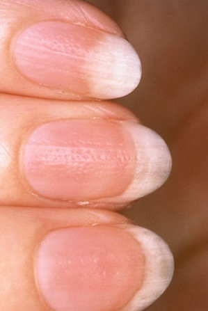 Health Info and Tips: Nail Can Describe Your Health