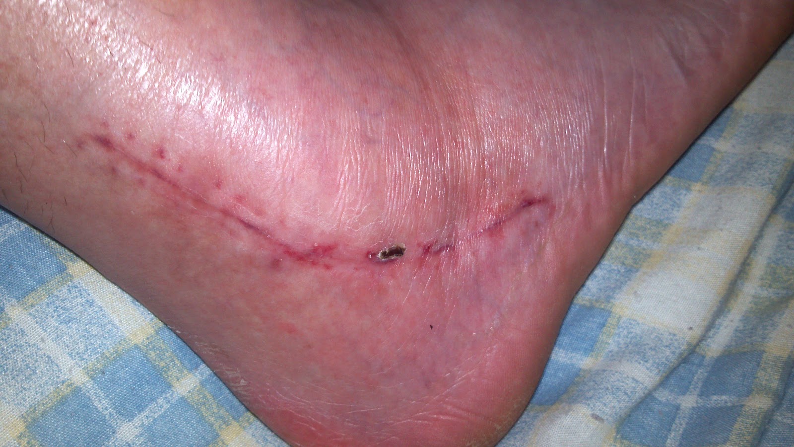 Chris' peroneal tendon surgery