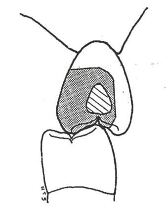 PROTESIS DENTAL : PONTICO