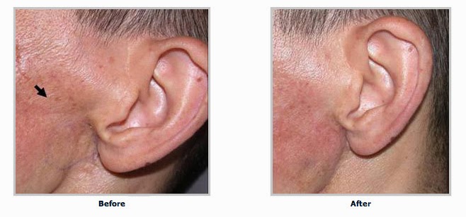 Medical Treatment Pictures-for Better Understanding: Superficial ...