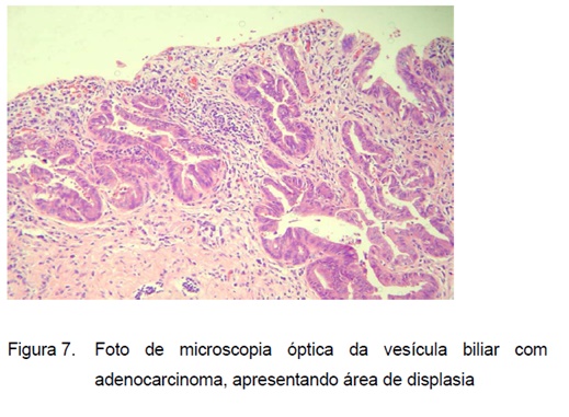 Atlas virtual de histologia e patologia: [CC II: #8] CARCINOMA DA ...