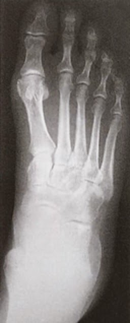 Posiciones Radiográficas de STIM: Rx Pie (Fte)